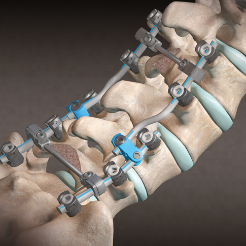 Spinal Products - KT Medical